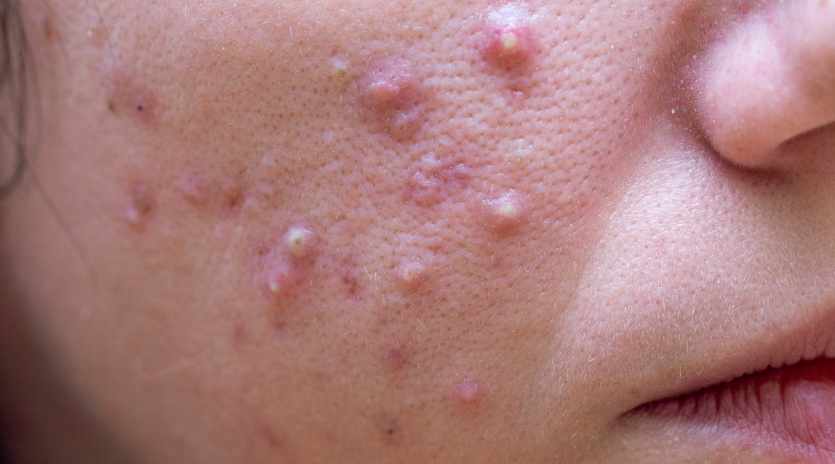 What Causes Acne and Types of Acne: A Deep Dive for Acne Awareness Mon